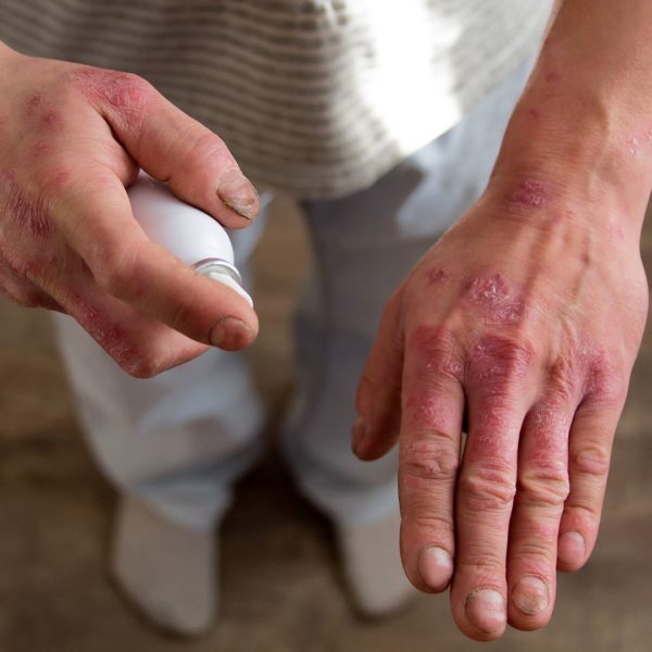 How do you treat rashes?