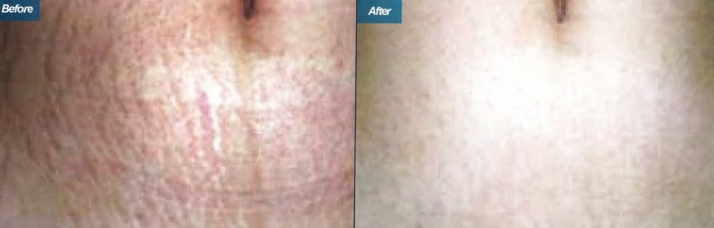 Micro-Needling Los Angeles CA - Collagen Induction Therapy